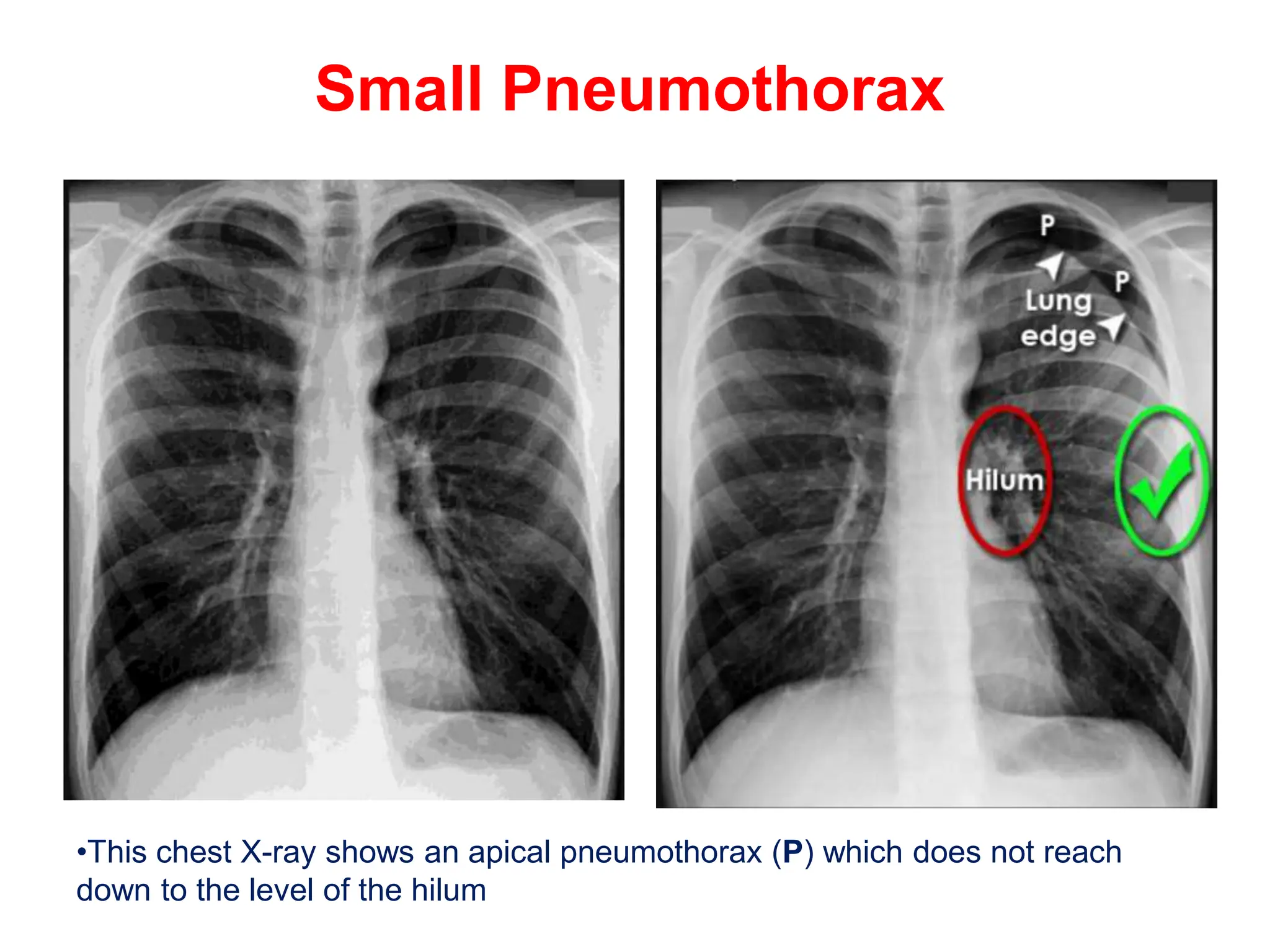 PNEUMOTHORAX IN CHEST XRAY INTERPRETATIONpptx | PPTX