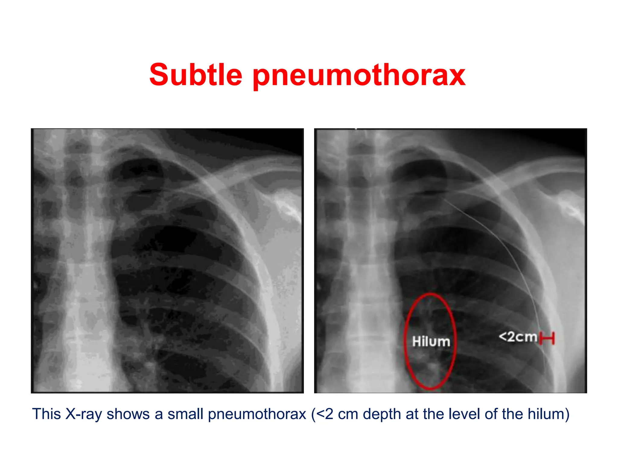 PNEUMOTHORAX IN CHEST XRAY INTERPRETATIONpptx | PPTX