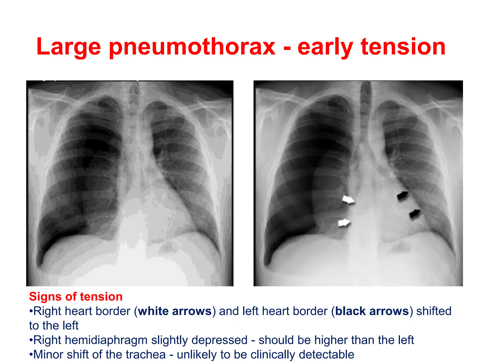 PNEUMOTHORAX IN CHEST XRAY INTERPRETATIONpptx | PPTX