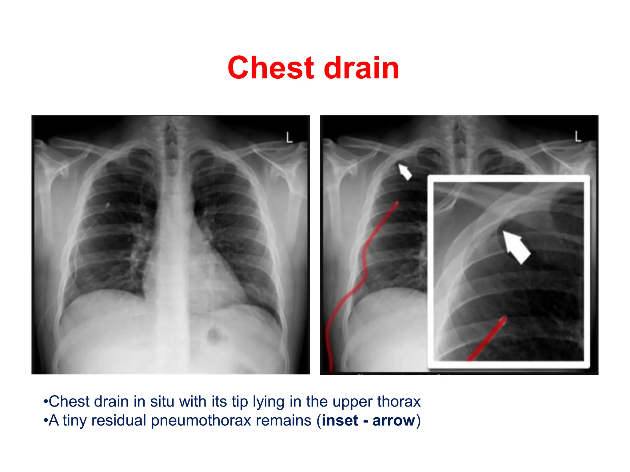 PNEUMOTHORAX IN CHEST XRAY INTERPRETATIONpptx | PPTX