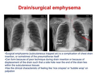 PNEUMOTHORAX IN CHEST XRAY INTERPRETATIONpptx | PPTX