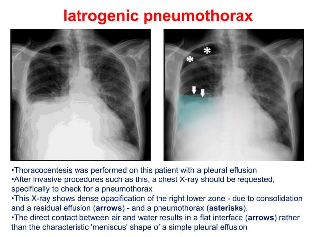 PNEUMOTHORAX IN CHEST XRAY INTERPRETATIONpptx | PPTX