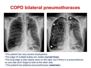 PNEUMOTHORAX IN CHEST XRAY INTERPRETATIONpptx | PPTX