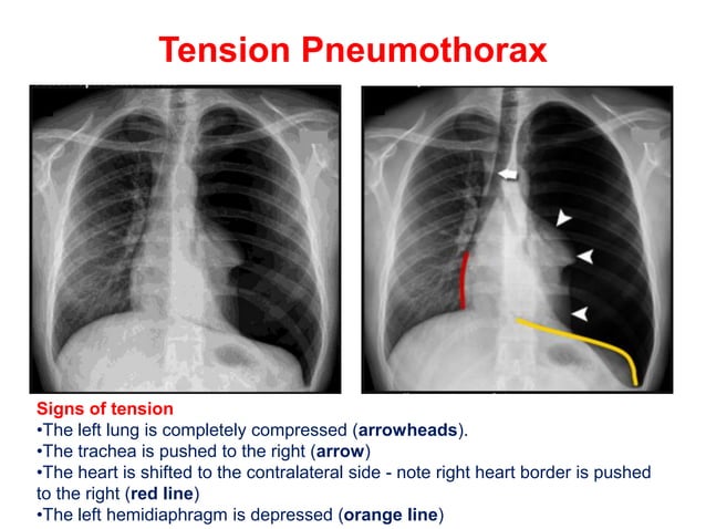 PNEUMOTHORAX IN CHEST XRAY INTERPRETATIONpptx | PPTX