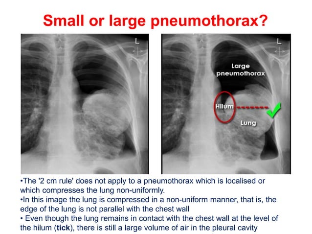 PNEUMOTHORAX IN CHEST XRAY INTERPRETATIONpptx | PPTX