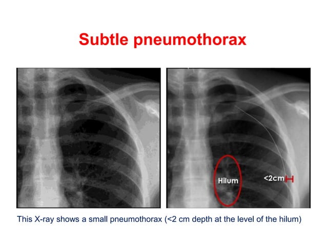 PNEUMOTHORAX IN CHEST XRAY INTERPRETATIONpptx | PPTX