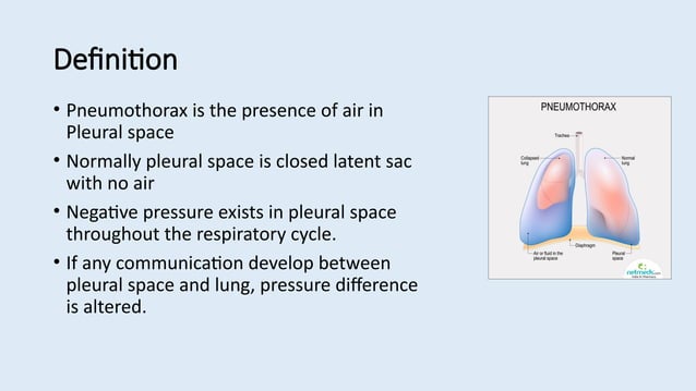 Pneumothorax PPT -----topic presentation | PPTX | Lung and Respiratory ...