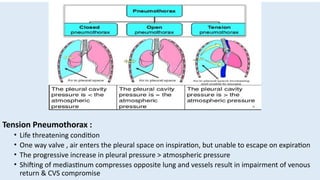 Pneumothorax PPT -----topic presentation | PPTX