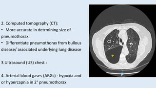 Pneumothorax PPT -----topic presentation | PPTX