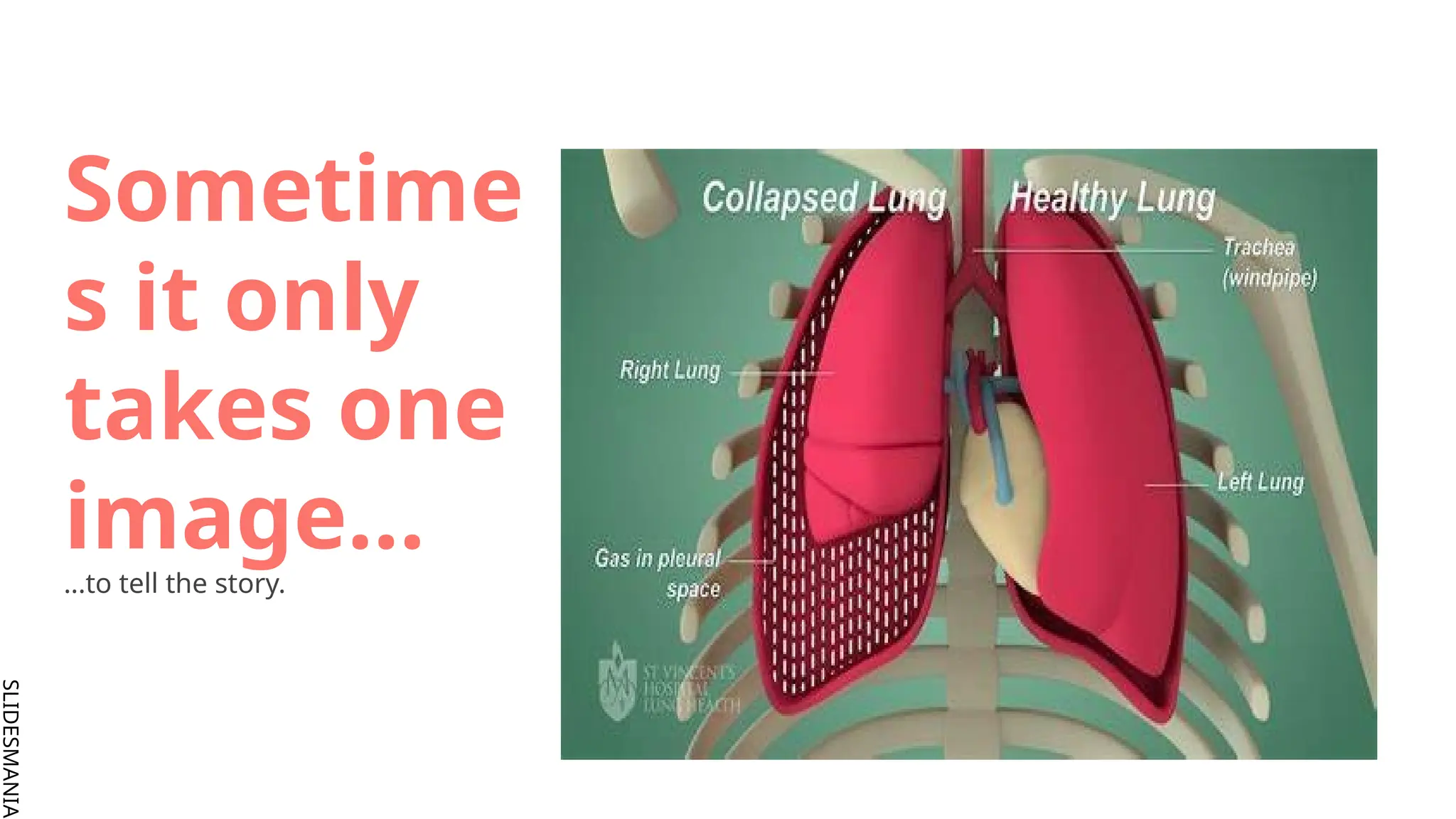 pneumothorax lung disease that cause by injury | PPT