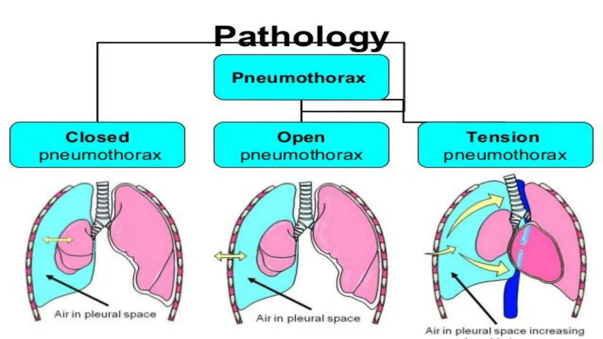 Respiratory System - Approach to Pneumothorax | PDF