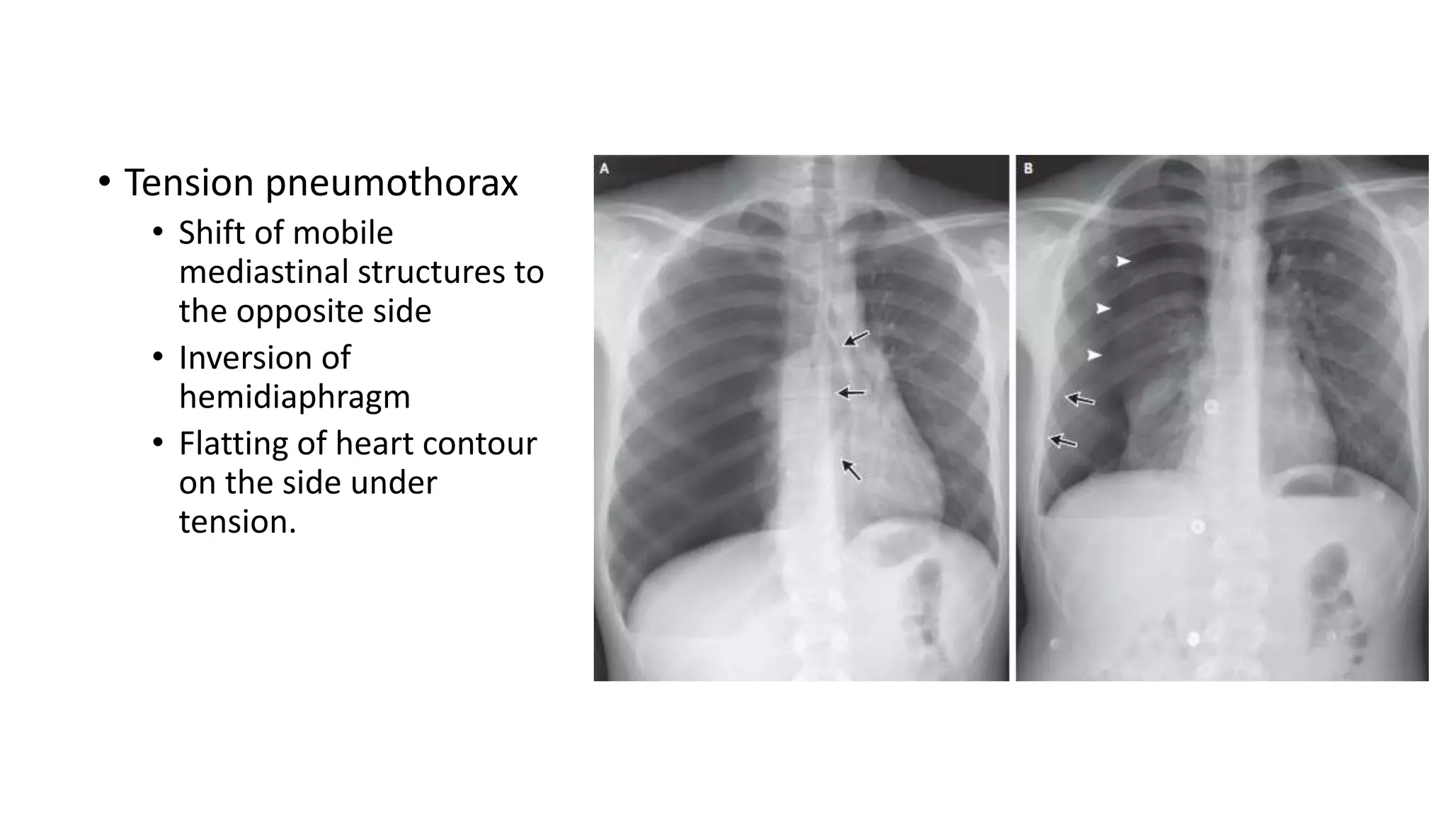 Pneumothorax case based | PPTX