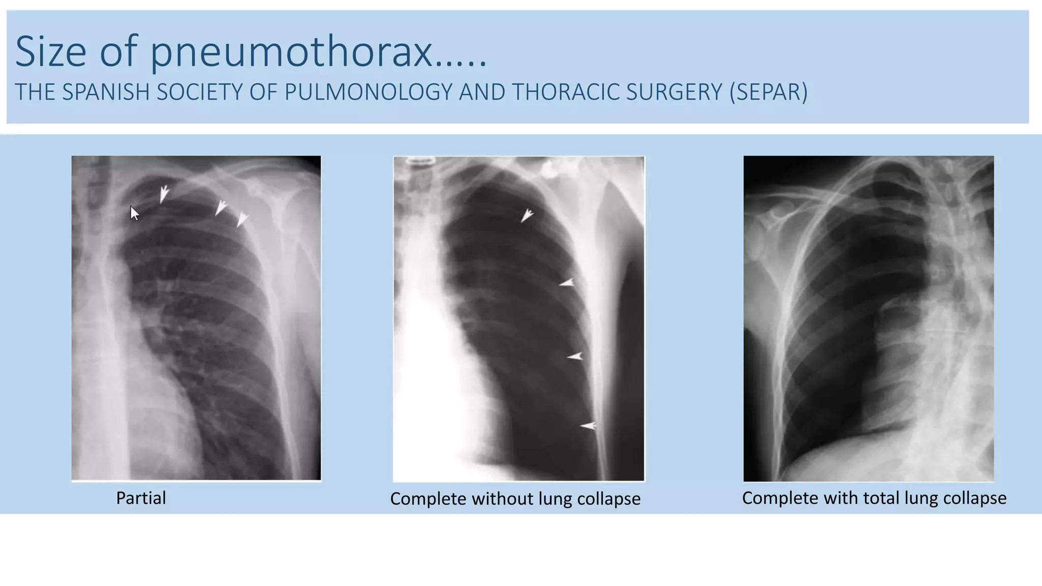 Pneumothorax case based | PPTX
