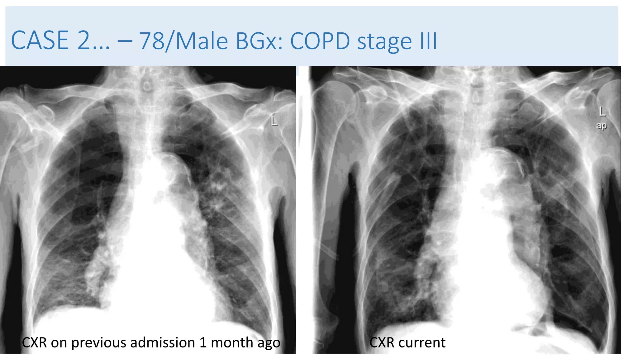Pneumothorax case based | PPTX