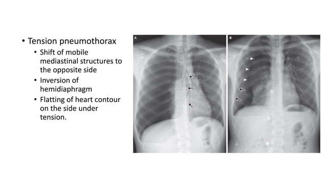 Pneumothorax case based | PPTX