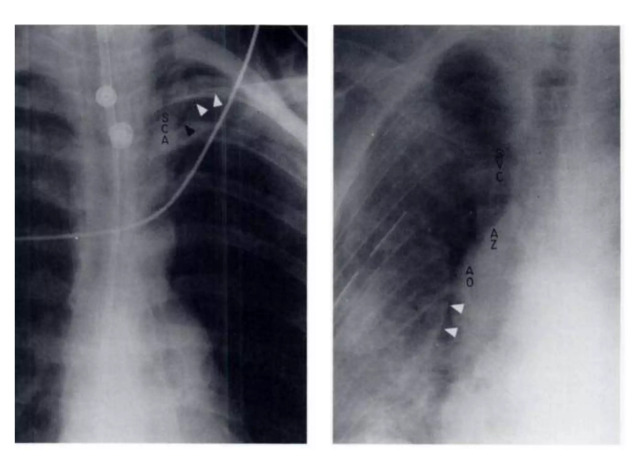 pneumothorax-ppt.pptx