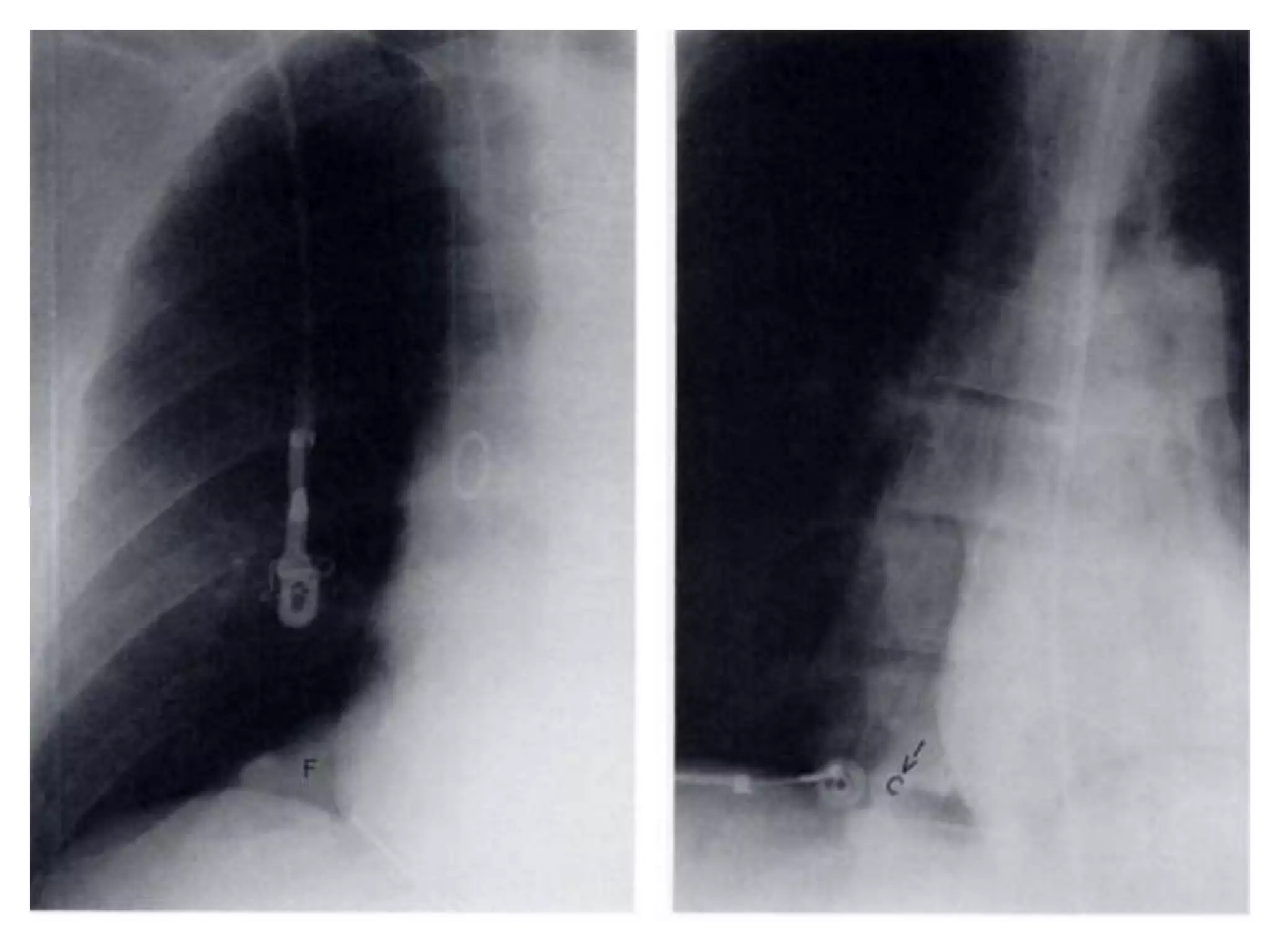 pneumothorax-ppt.pptx