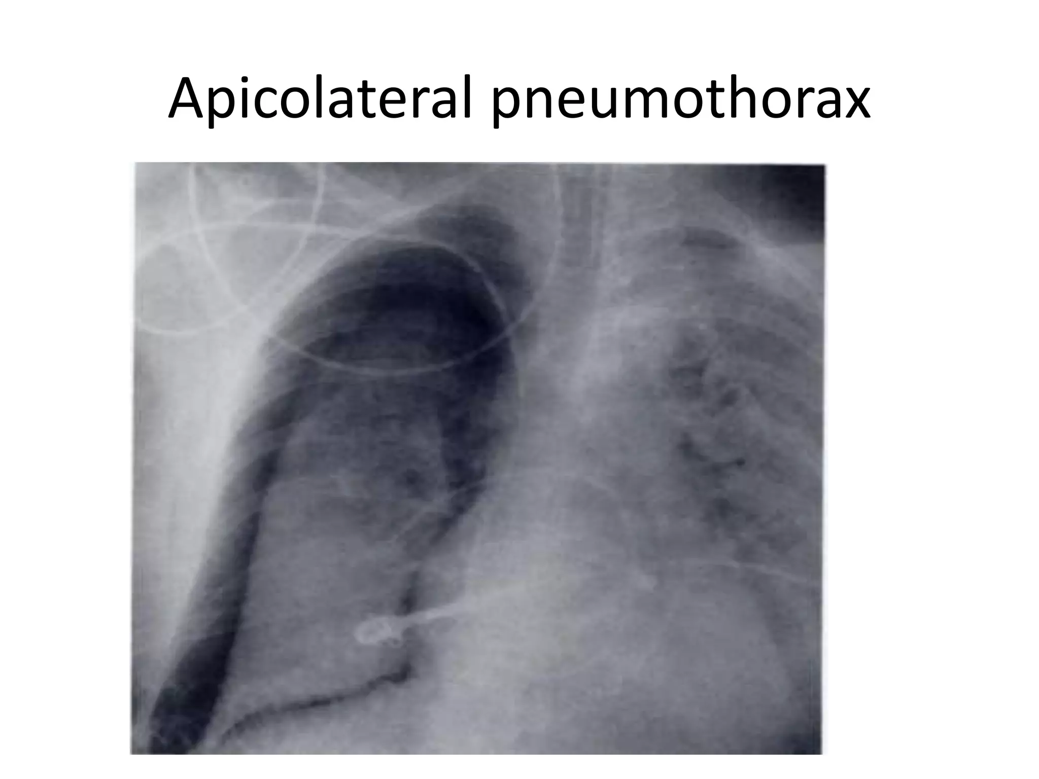 pneumothorax-ppt.pptx