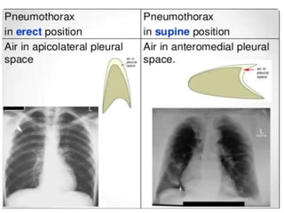 pneumothorax-ppt.pptx