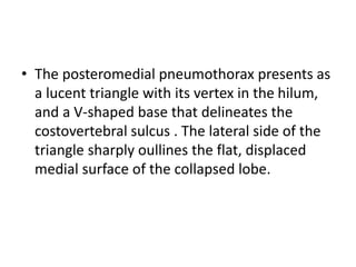 pneumothorax-ppt.pptx