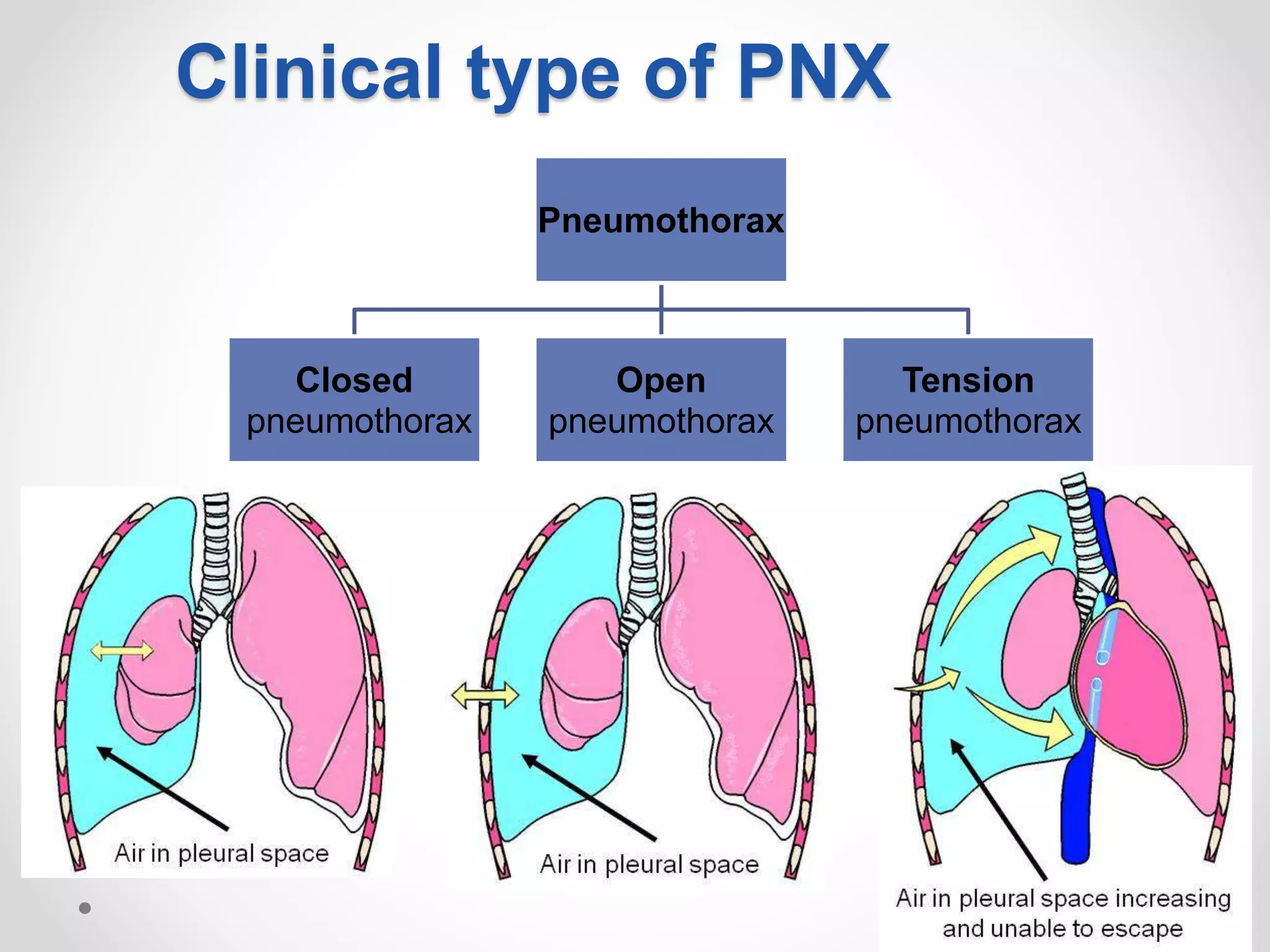 Pneumothorax | PPTX