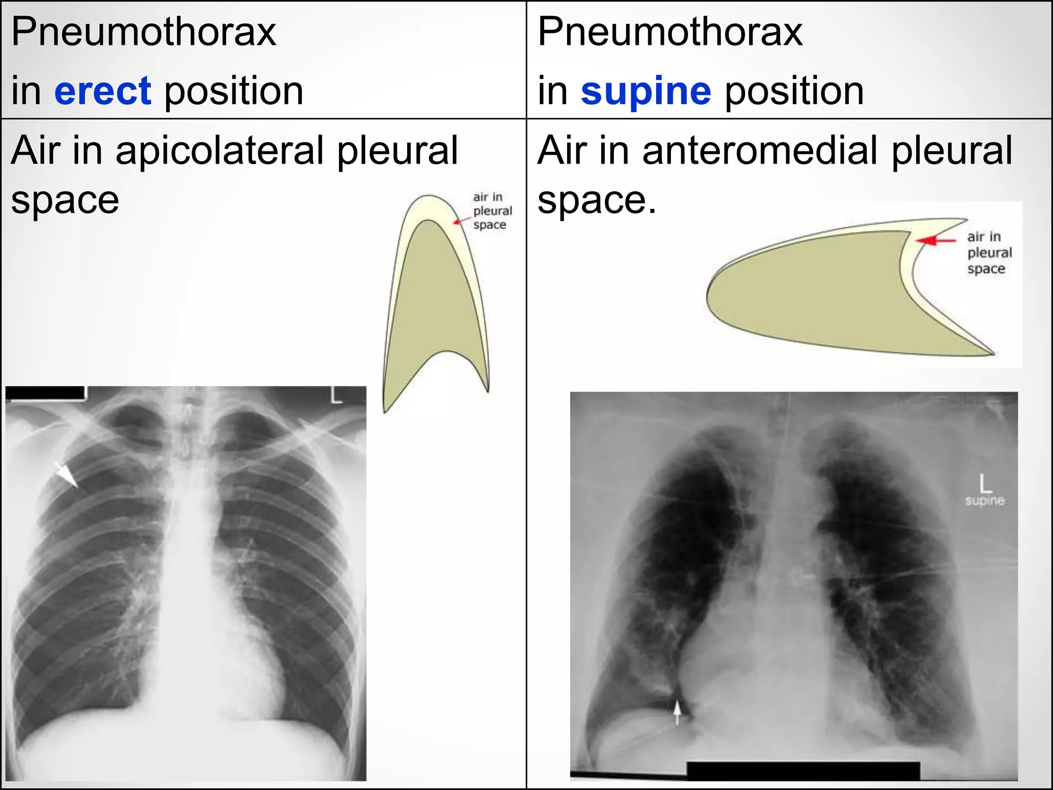 Pneumothorax | PPTX
