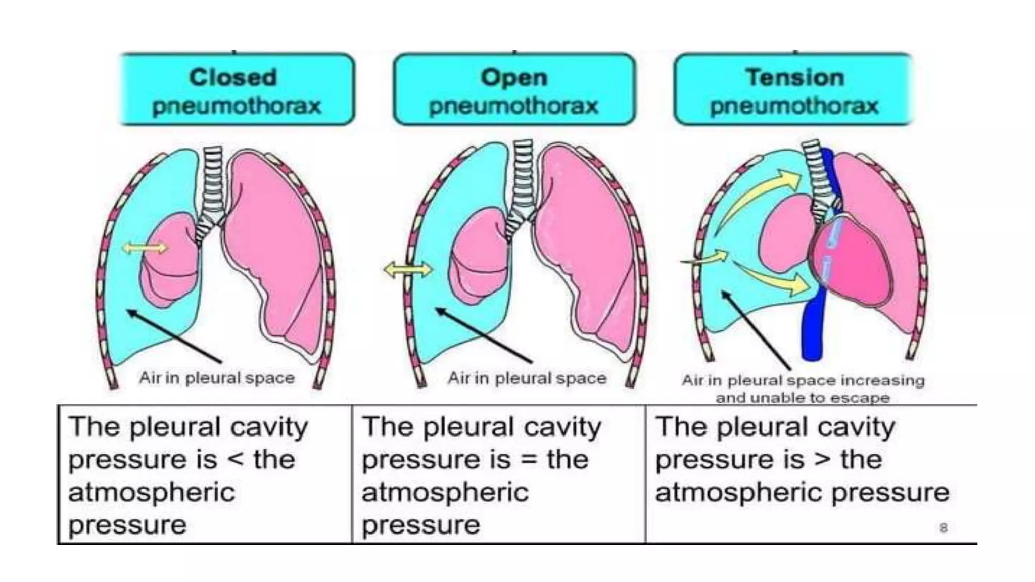 PNEUMOTHORAX_075811.pptx