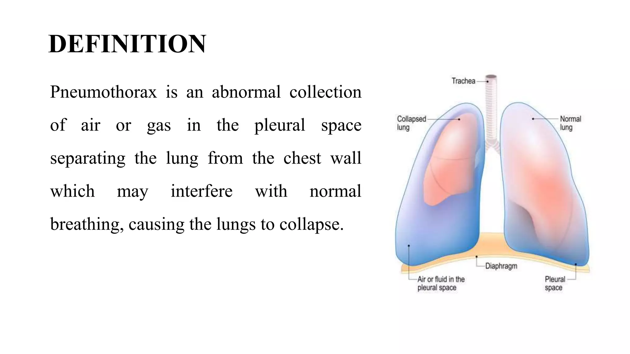PNEUMOTHORAX_075811.pptx