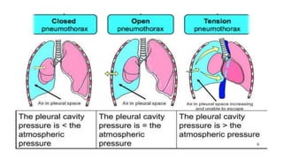 PNEUMOTHORAX_075811.pptx