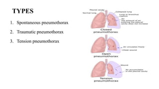 PNEUMOTHORAX_075811.pptx