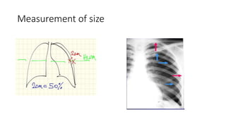 Pneumothorax .pptx
