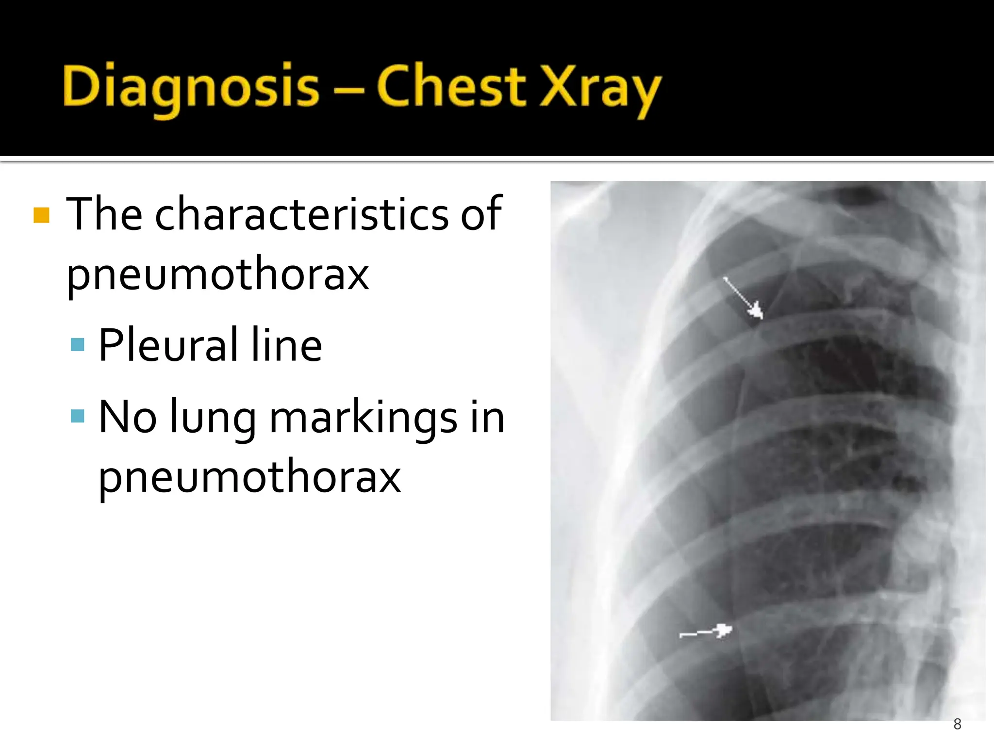 pneumothorax 1.pptx definition, types, clinical features, diagnosis ...