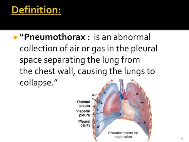 pneumothorax 1.pptx definition, types, clinical features, diagnosis, treatment | PPTX | Lung and ...