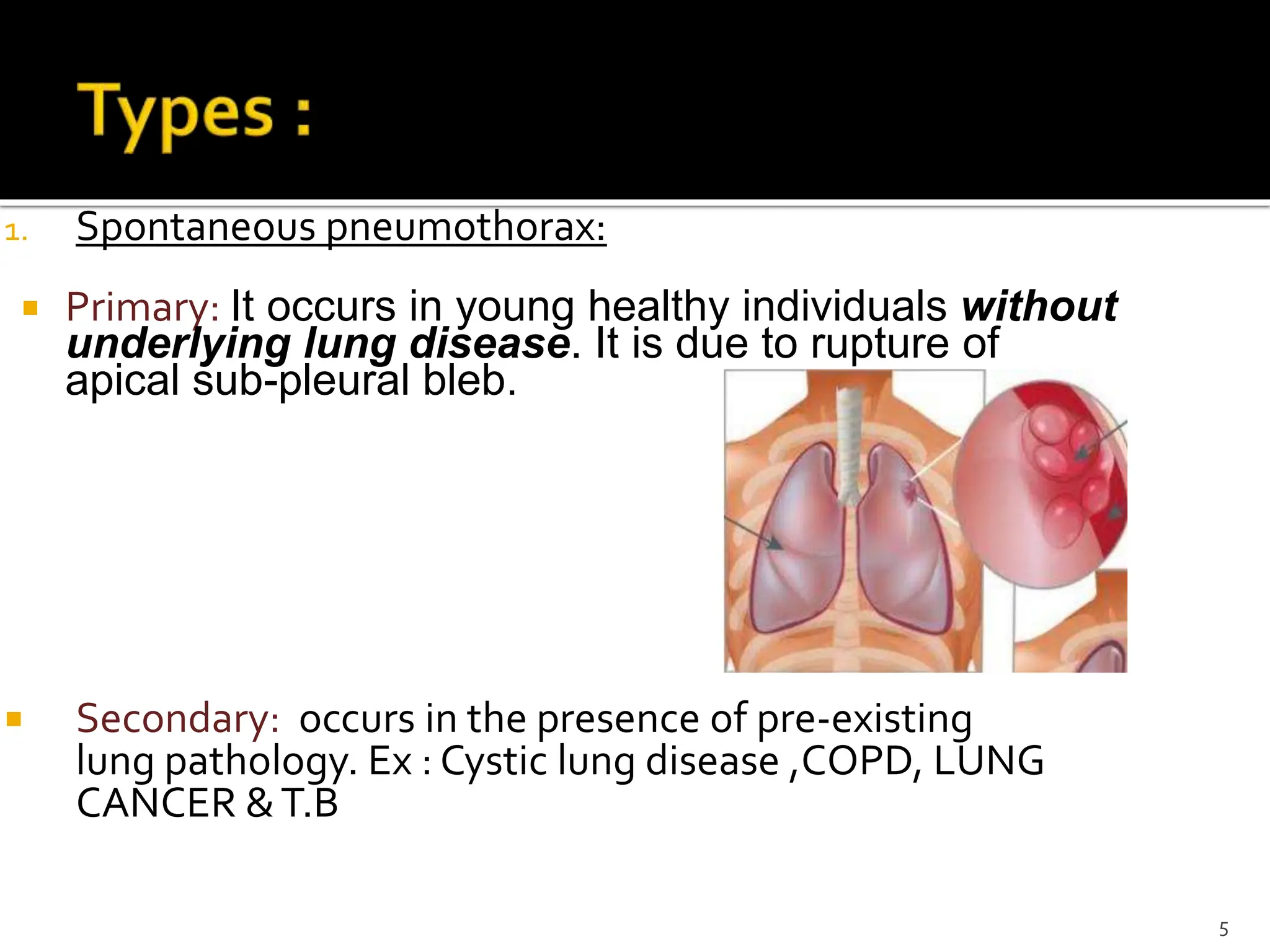 Pneumothorax 1 Pptx Definition Types Clinical Features Diagnosis Treatment Ppt