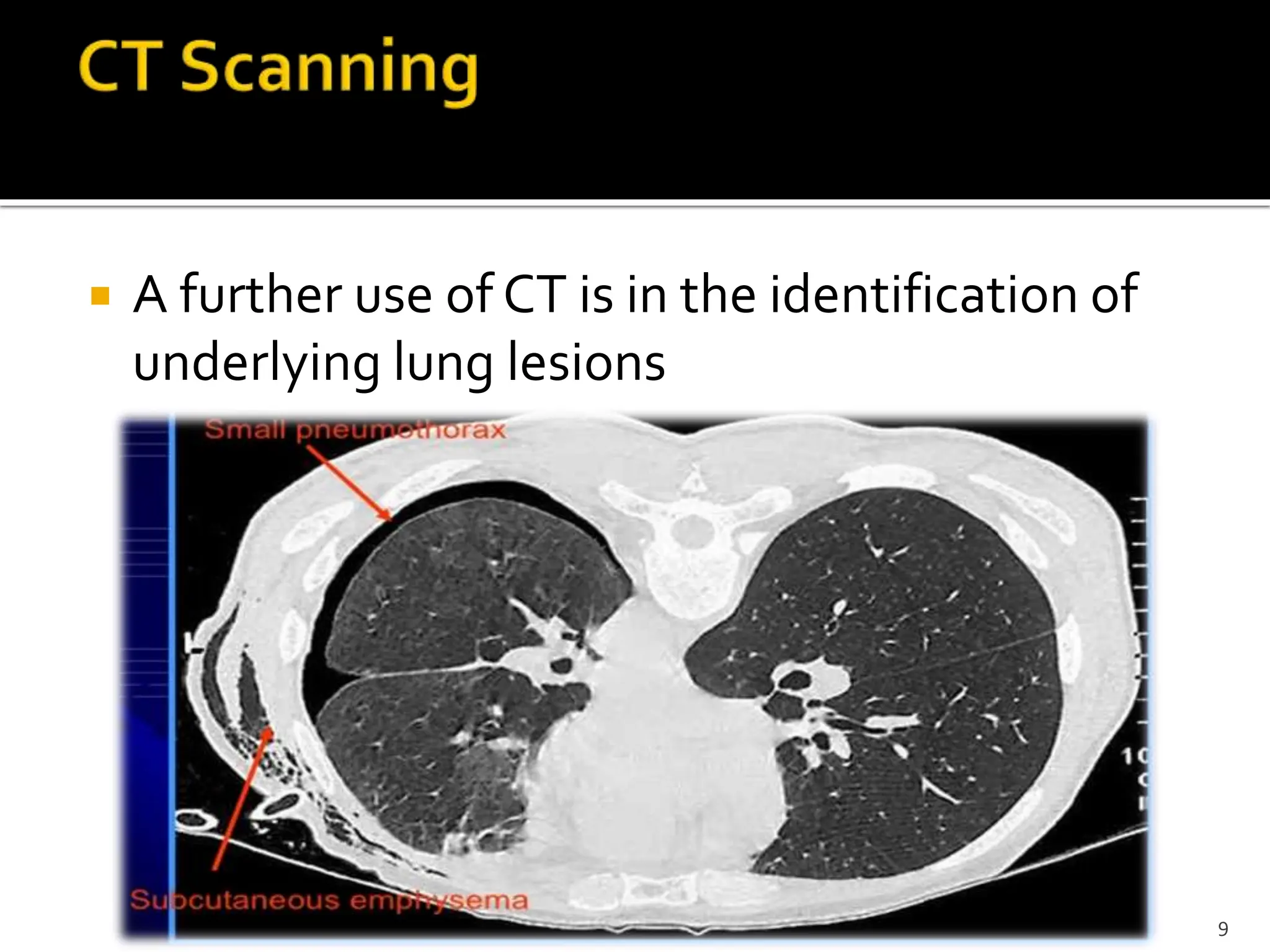 Pneumothorax 1 Pptx Definition Types Clinical Features Diagnosis Treatment Ppt