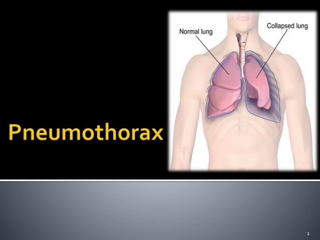 pneumothorax 1.pptx definition, types, clinical features, diagnosis ...
