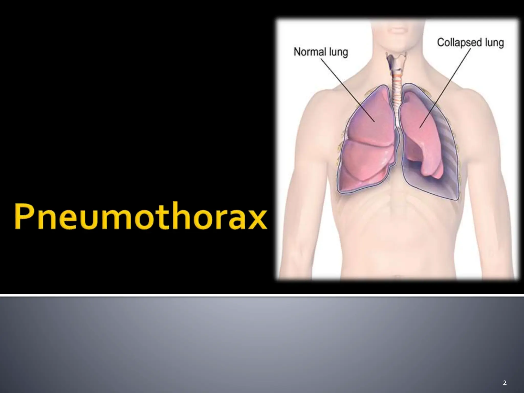 pneumothorax 1.pptx definition, types, clinical features, diagnosis, treatment | PPTX