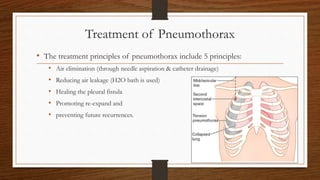 Pneumothorax ABC Assessment | PPTX