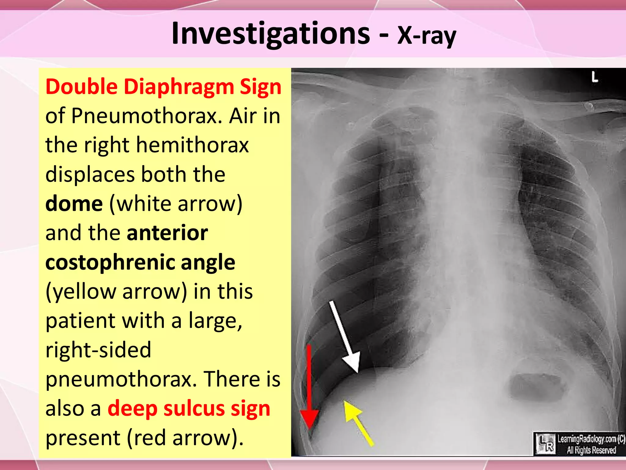 Pneumothorax and pneumomediastinum | PDF