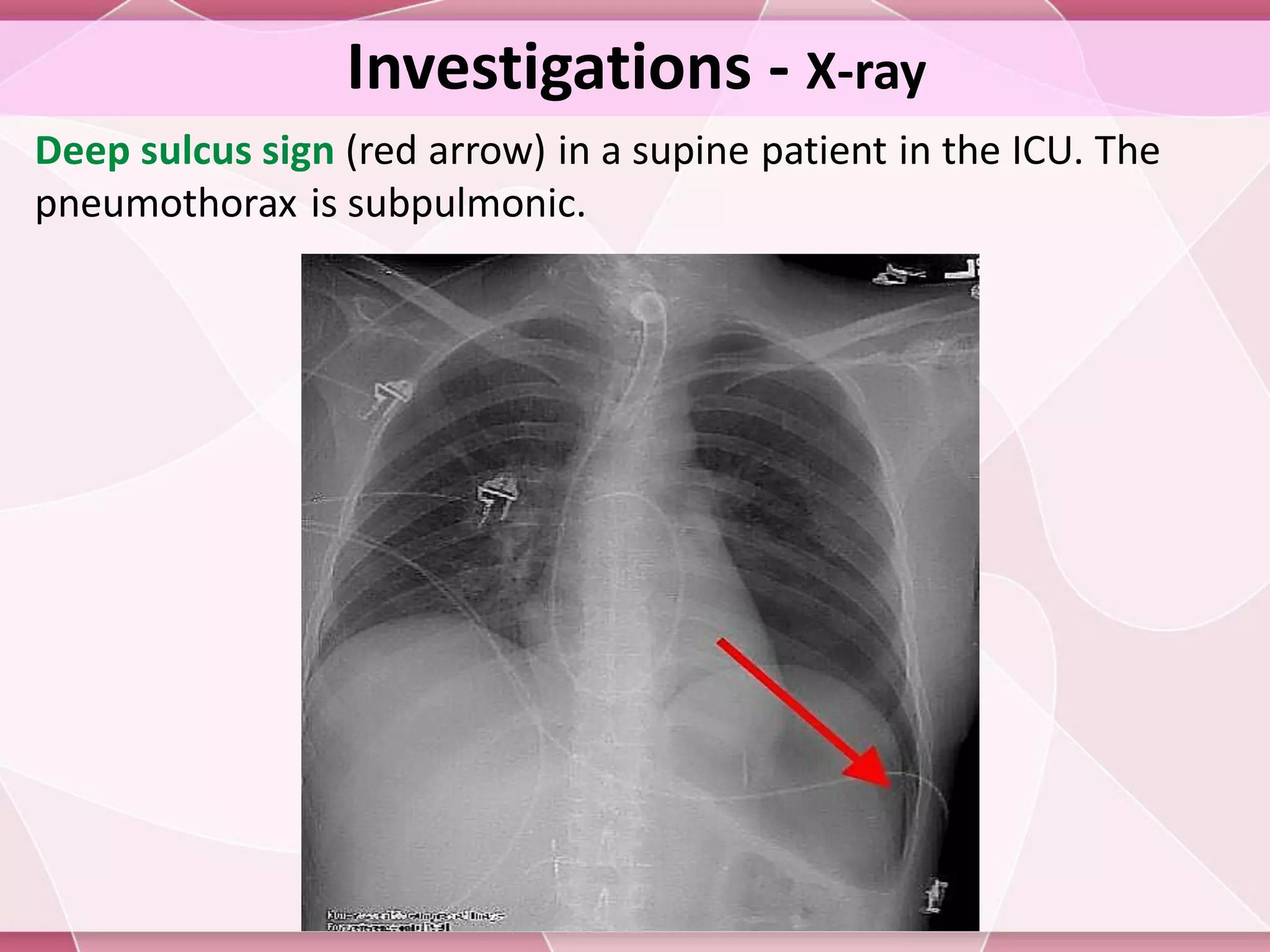 Pneumothorax and pneumomediastinum | PDF