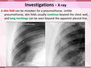 Pneumothorax and pneumomediastinum | PDF