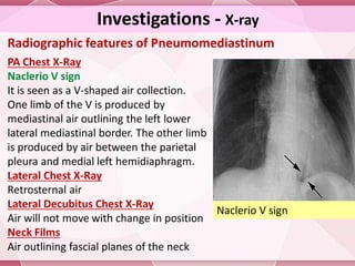 Pneumothorax and pneumomediastinum | PDF