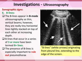 Pneumothorax and pneumomediastinum | PDF