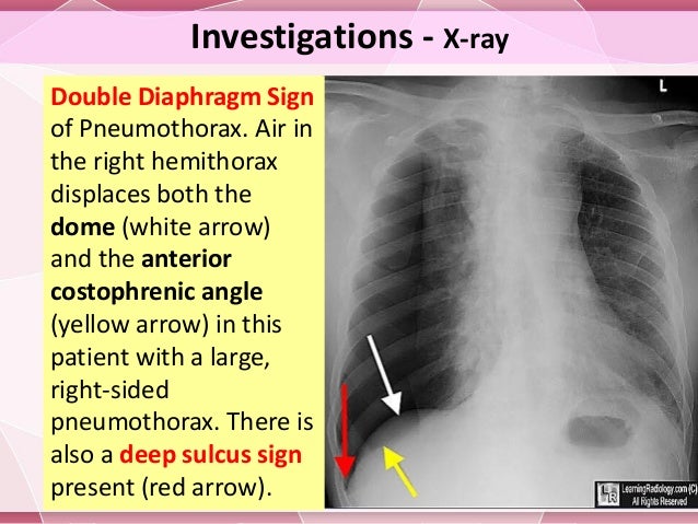 Pneumothorax and pneumomediastinum