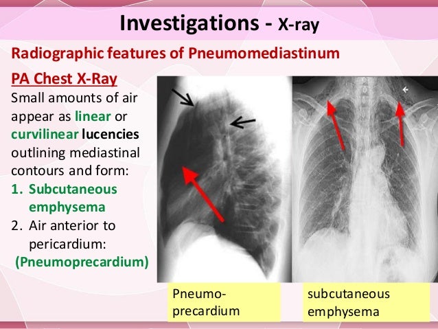 Pneumothorax and pneumomediastinum