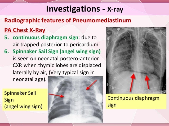 Pneumothorax and pneumomediastinum