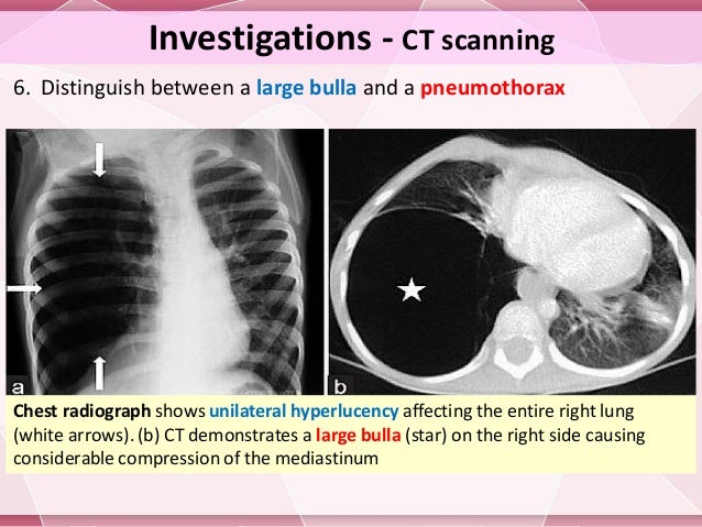 Pneumothorax and pneumomediastinum