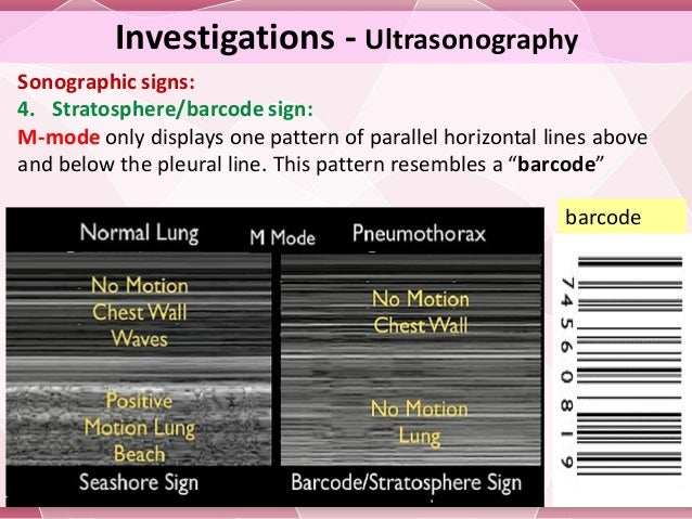 Pneumothorax and pneumomediastinum