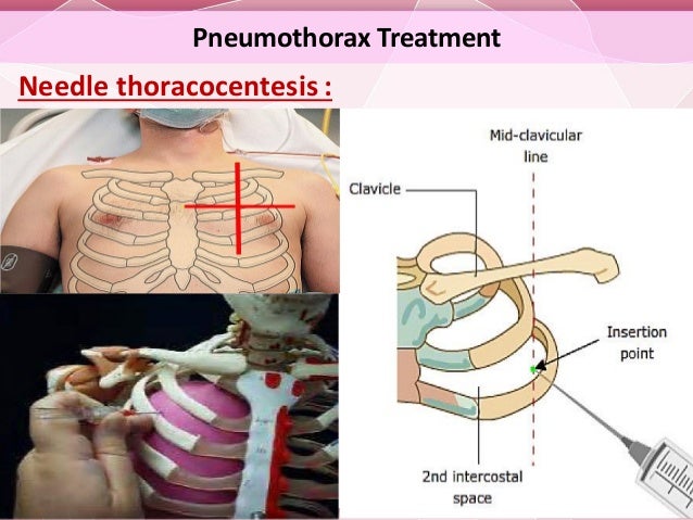 Pneumothorax and pneumomediastinum