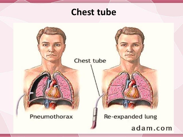 Chest Tube For Pneumothorax